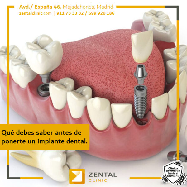 Qué Debes Saber Antes De Ponerte Un Implante Dental Zental Clinic